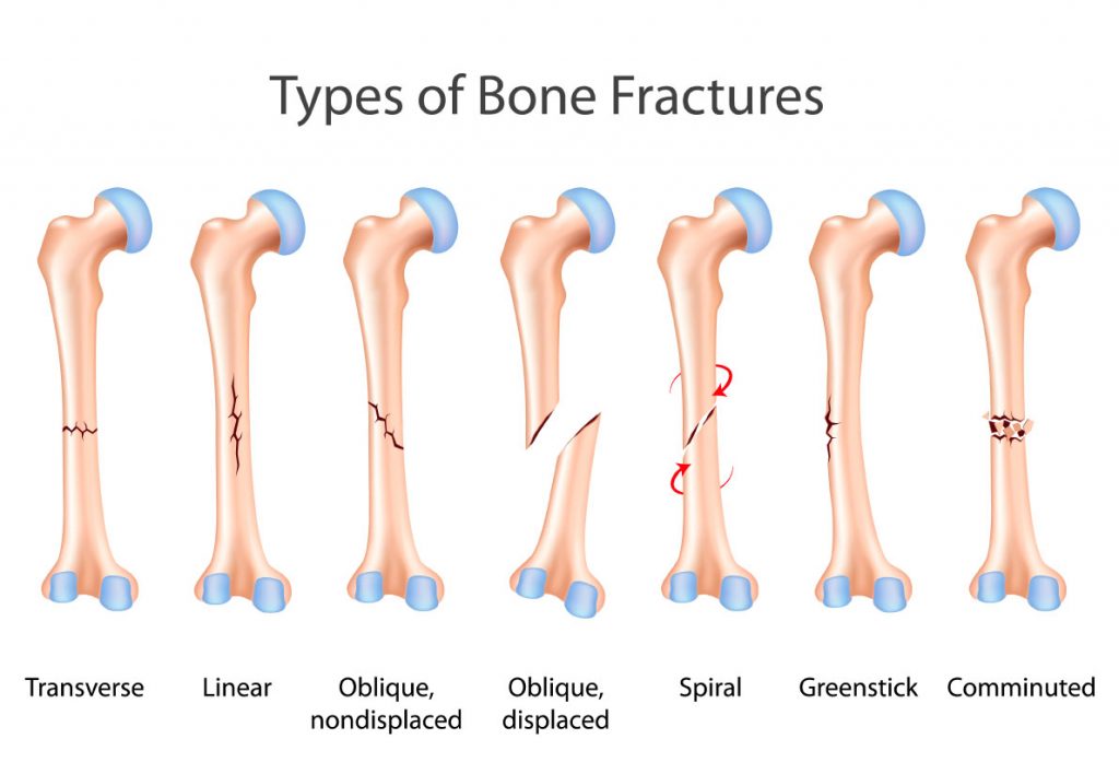 Broken Bones And Fractures